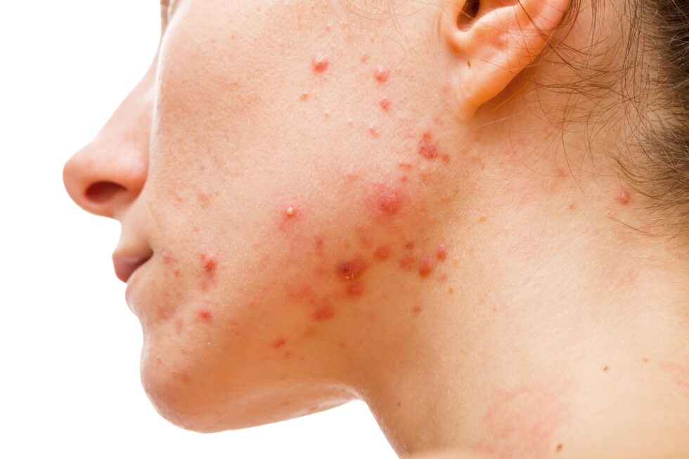 Acne persistente nem sempre é só dermatológica: quando a pele pode ...